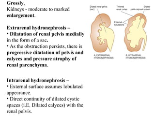 SGD renal stones, hydronephrosis renal system pptx | PPTX