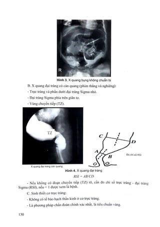 SGK Giãn đại tràng bẩm sinh ở trẻ em.pdf