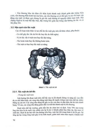 SGK Hội chứng tắc ruột Y4.pdf rất hay nha các bạn trẻ | PDF