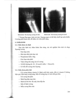 SGK mới bệnh còi xương ở trẻ em.pdf hay nha | PDF