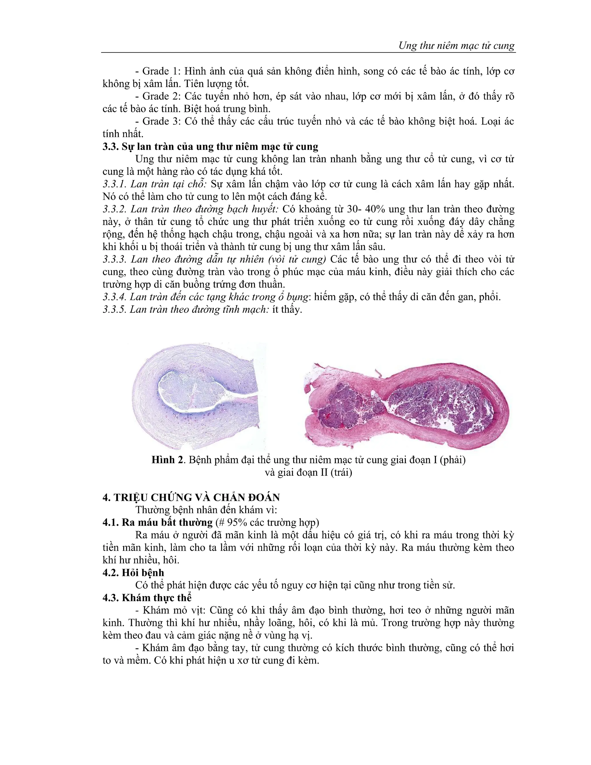 SGK sản Huế ung thư niêm mạc tử cung.pdf