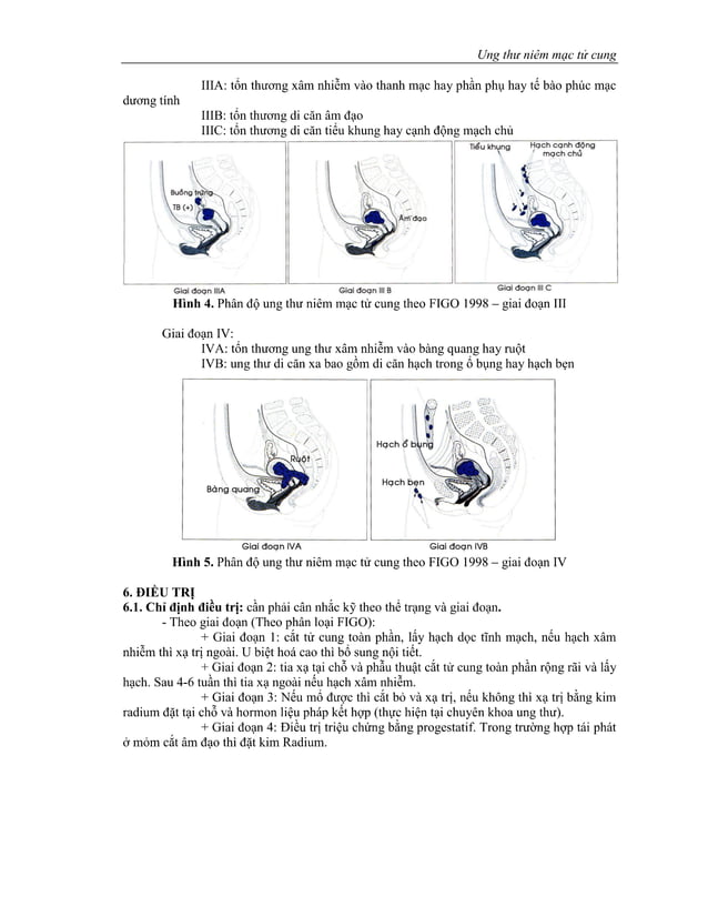SGK sản Huế ung thư niêm mạc tử cung.pdf