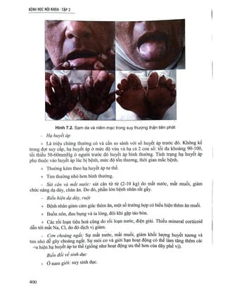 SGK Suy thượng thận mạn tính YHN.pdf