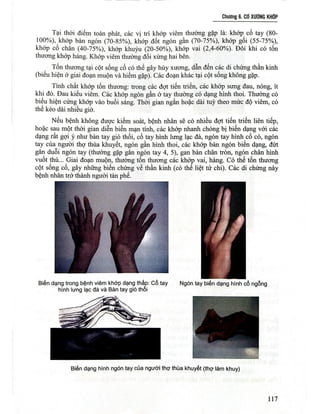 SGK VIÊM KHỚP DẠNG THẤP YHN .pdf