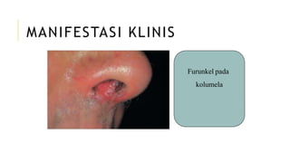 SGL-FRUNKEL PADA HIDUNG.pptx