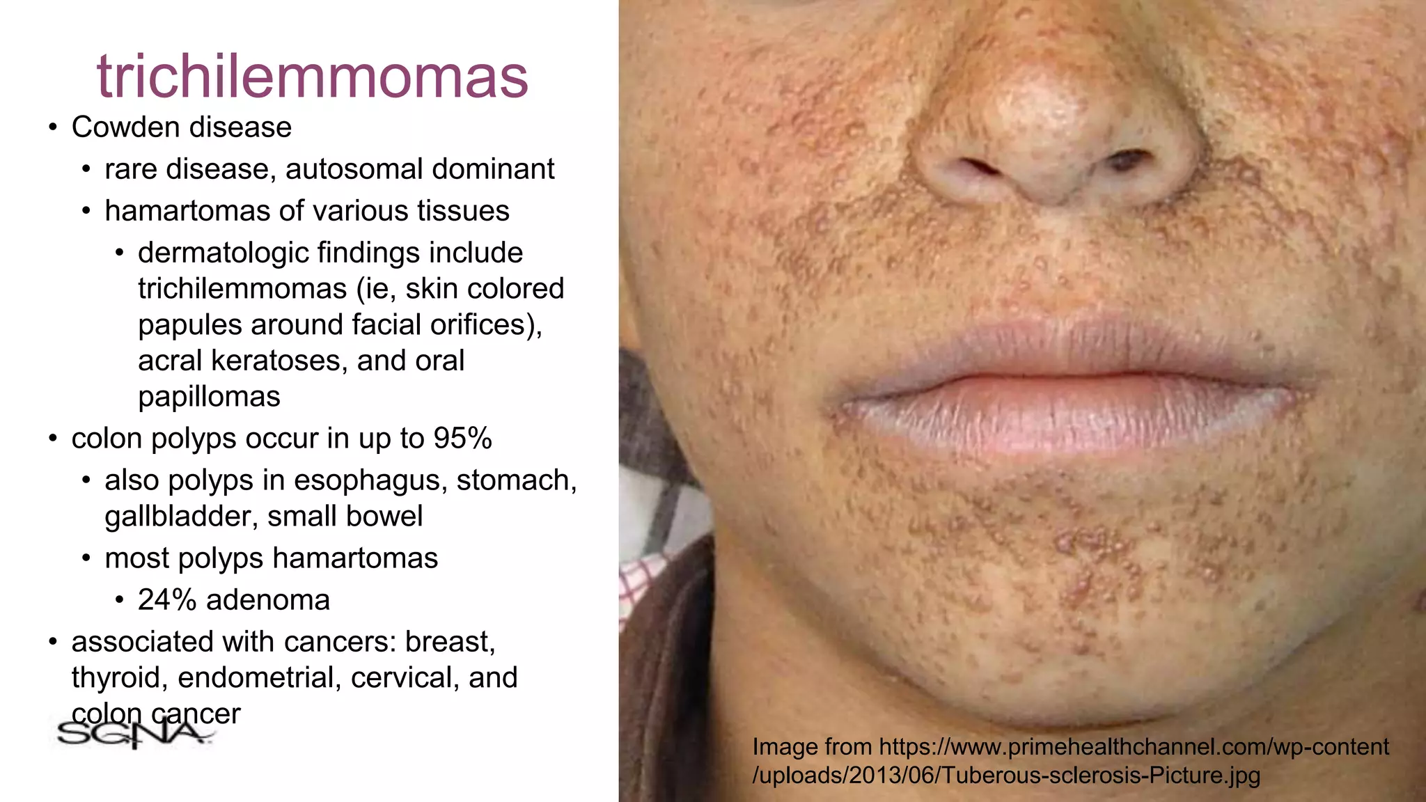 Know GI Inside & Out? Recognizing Skin Lesions of GI Disorders | PPTX