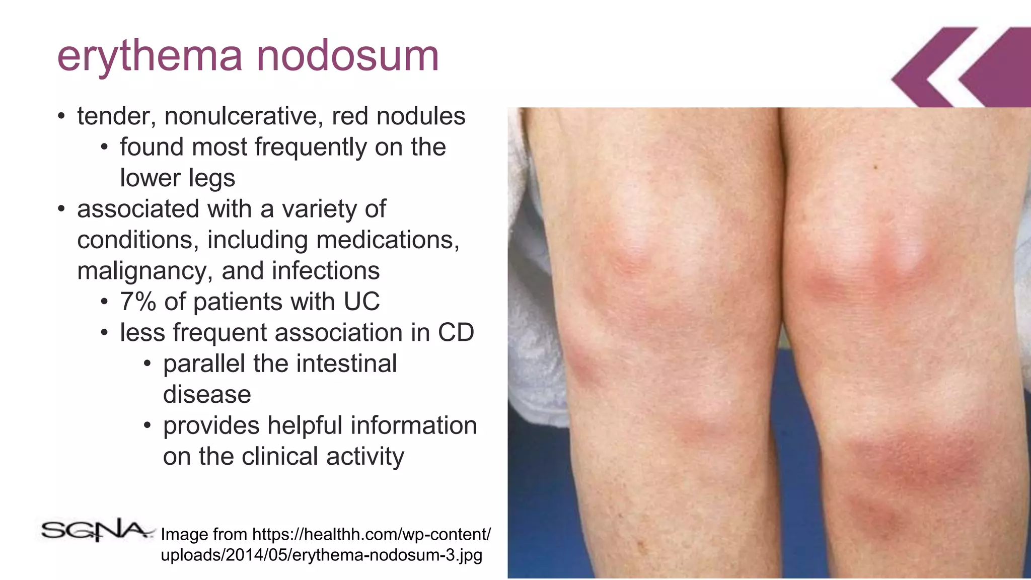 Know GI Inside & Out? Recognizing Skin Lesions of GI Disorders | PPTX