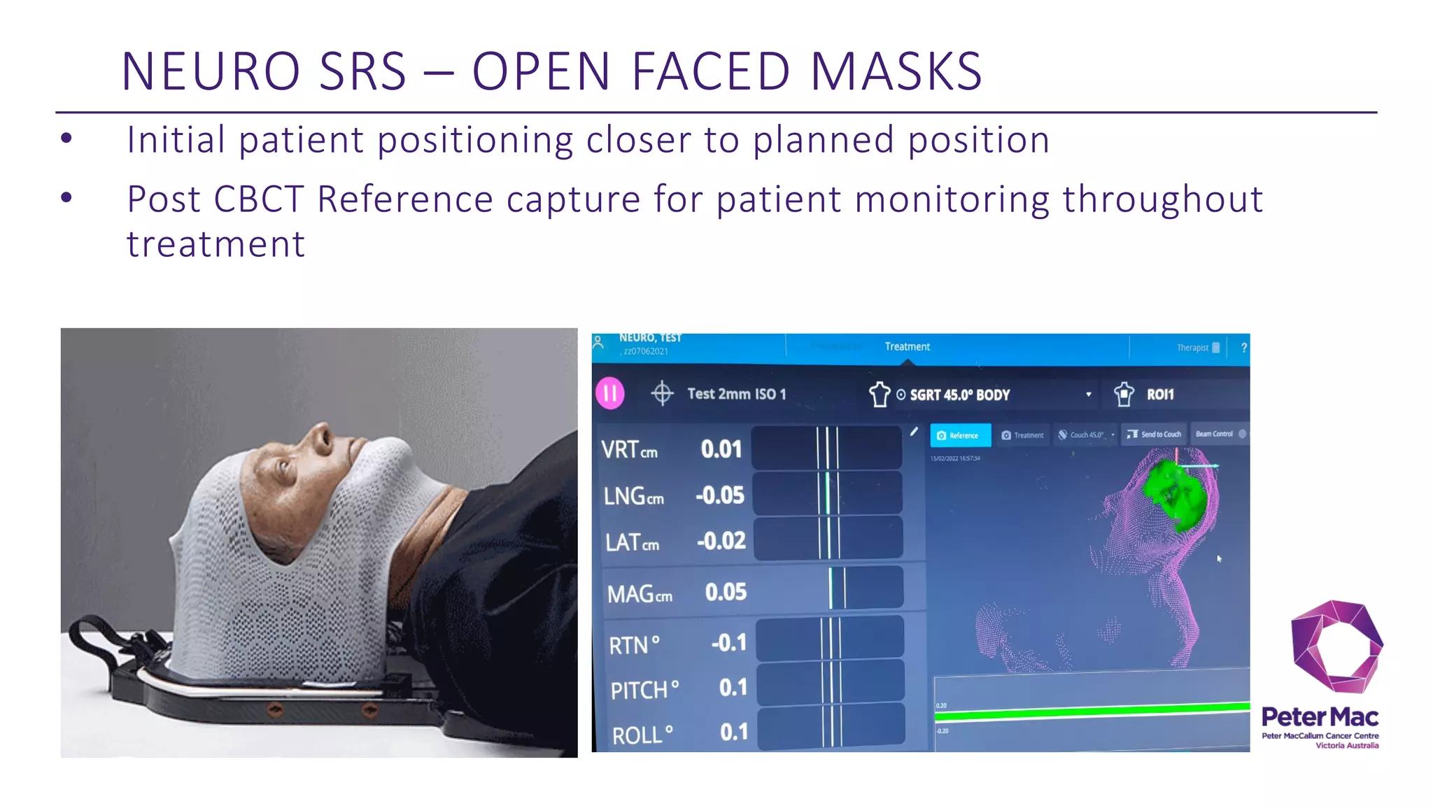 We Can See Clearly Now: Implementation of Surface Guided Radiation Therapy | PDF