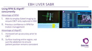 We Can See Clearly Now: Implementation of Surface Guided Radiation ...