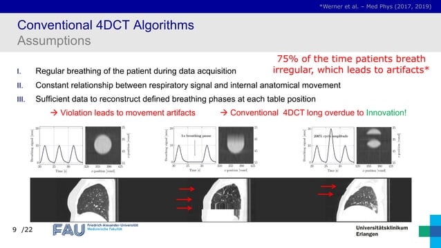 SGRT in Sim Usage of Surface Monitoring for Breathing-adapted Four-dimensional Computed ...