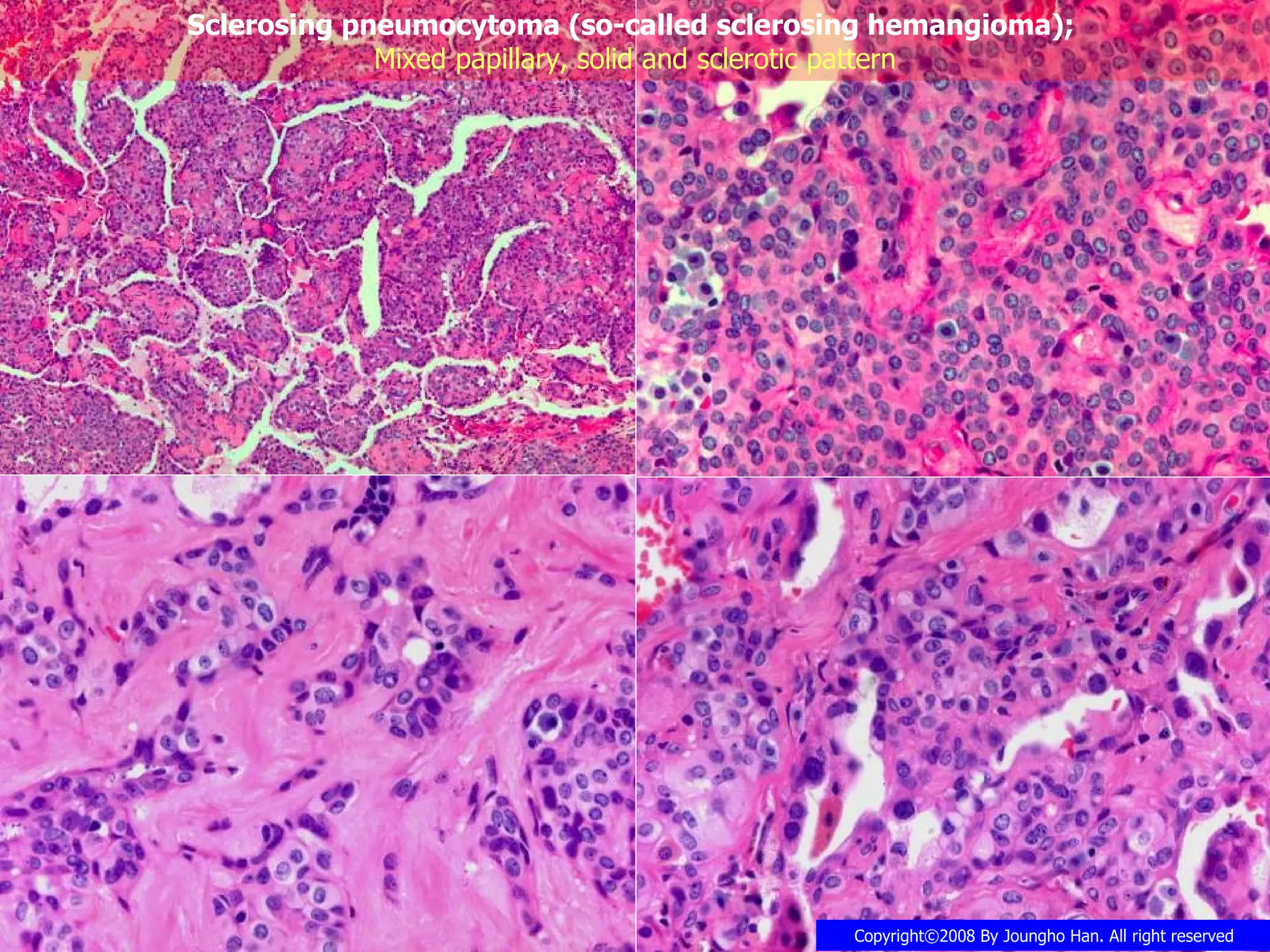 sclerosing hemangioma | PPS