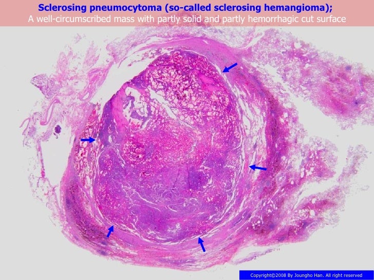 sclerosing hemangioma