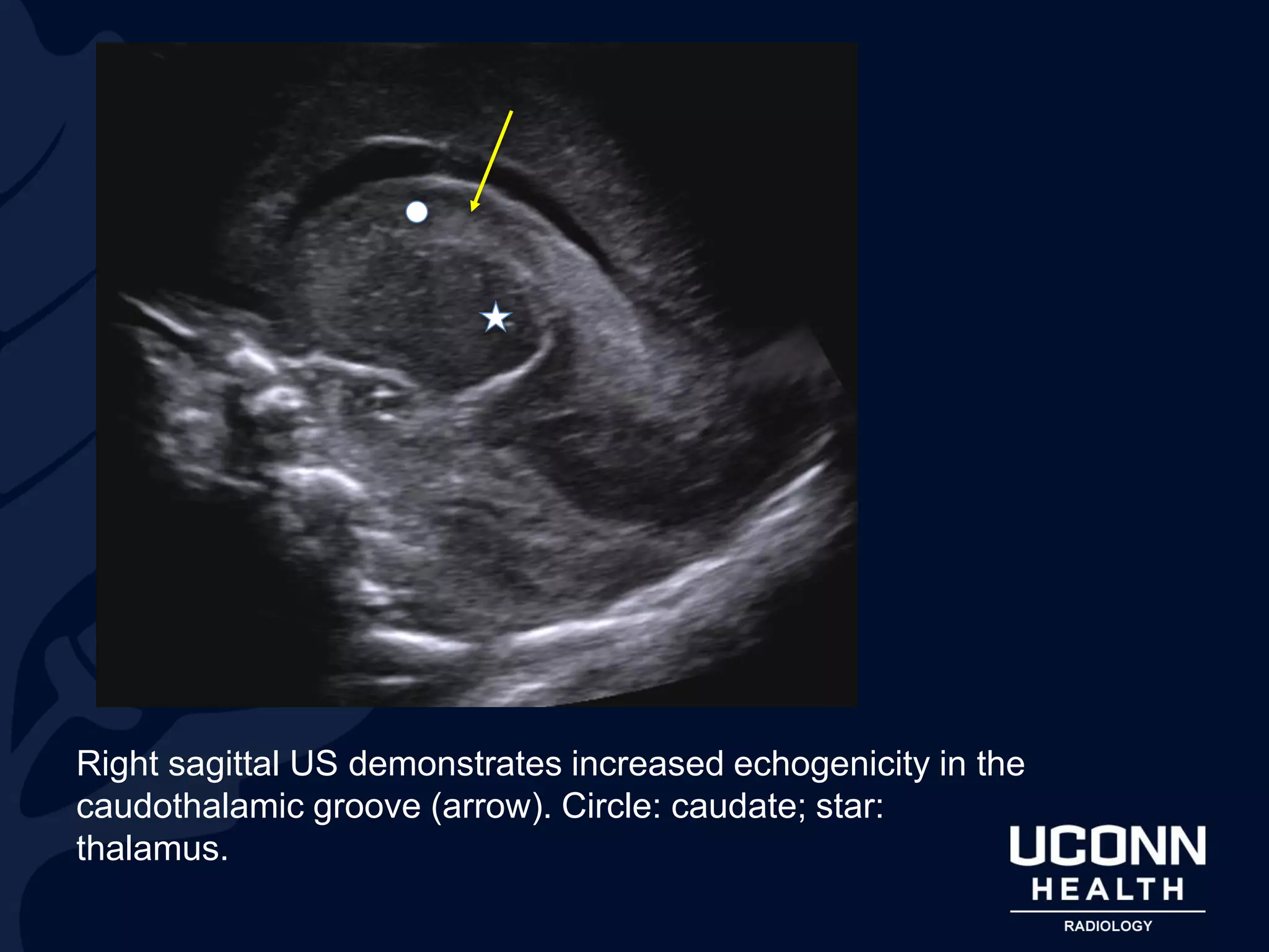 SH-13-Peds-US-Neuro-Grade-I-germinal-matrix-hemorrhage.pdf
