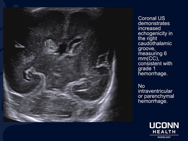 Sh 13 Peds Us Neuro Grade I Germinal Matrix Hemorrhage Pdf