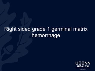 Germinal Matrix Hemorrhage Diagram