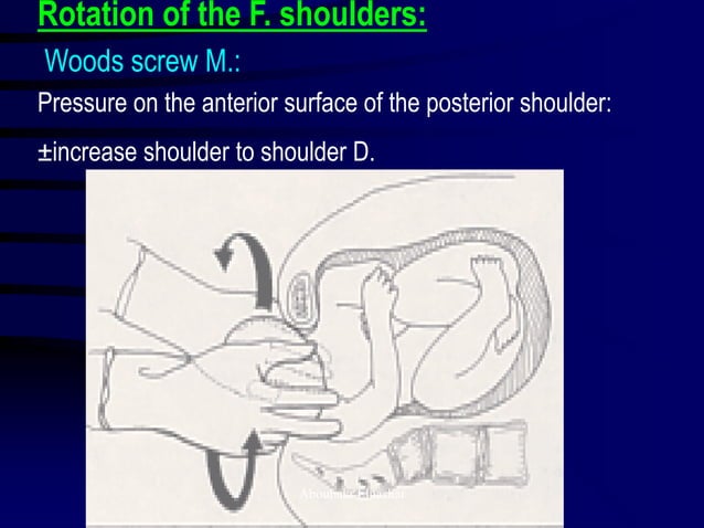 Shoulder dystocia | PDF