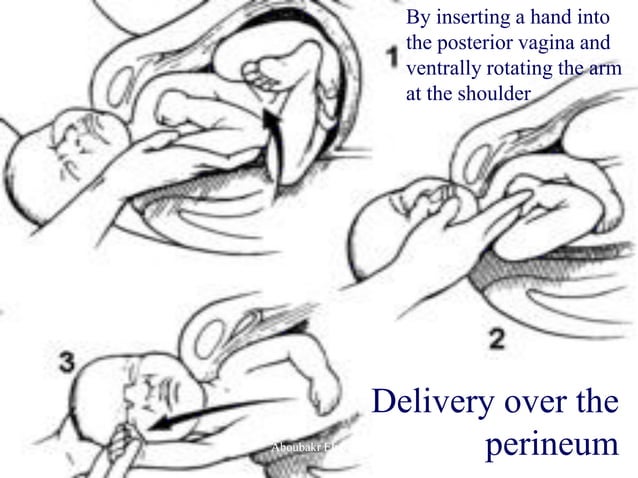 Shoulder dystocia | PDF