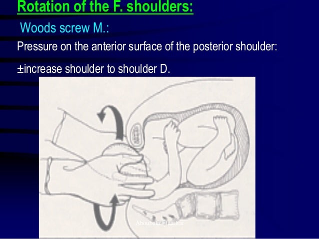Shoulder dystocia