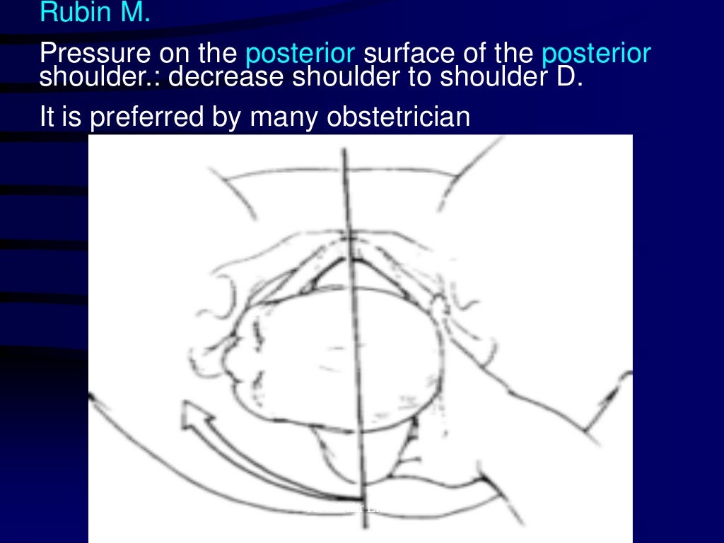 Shoulder Dystocia