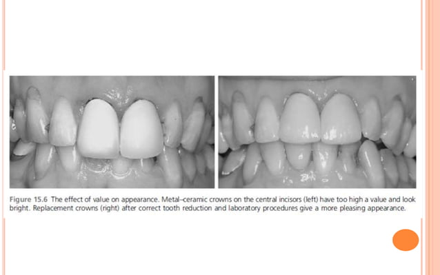 Shade selection | PPTX | Dental Health | Diseases and Conditions