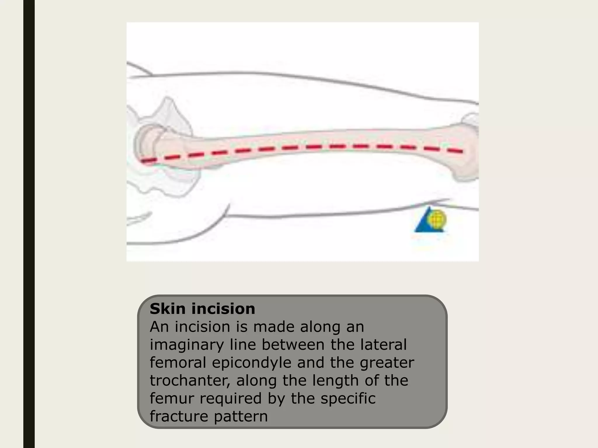 Shaft femur | PPTX