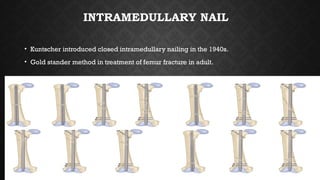 Comprehensive Management of Femoral Shaft Fractures: Anatomy ...