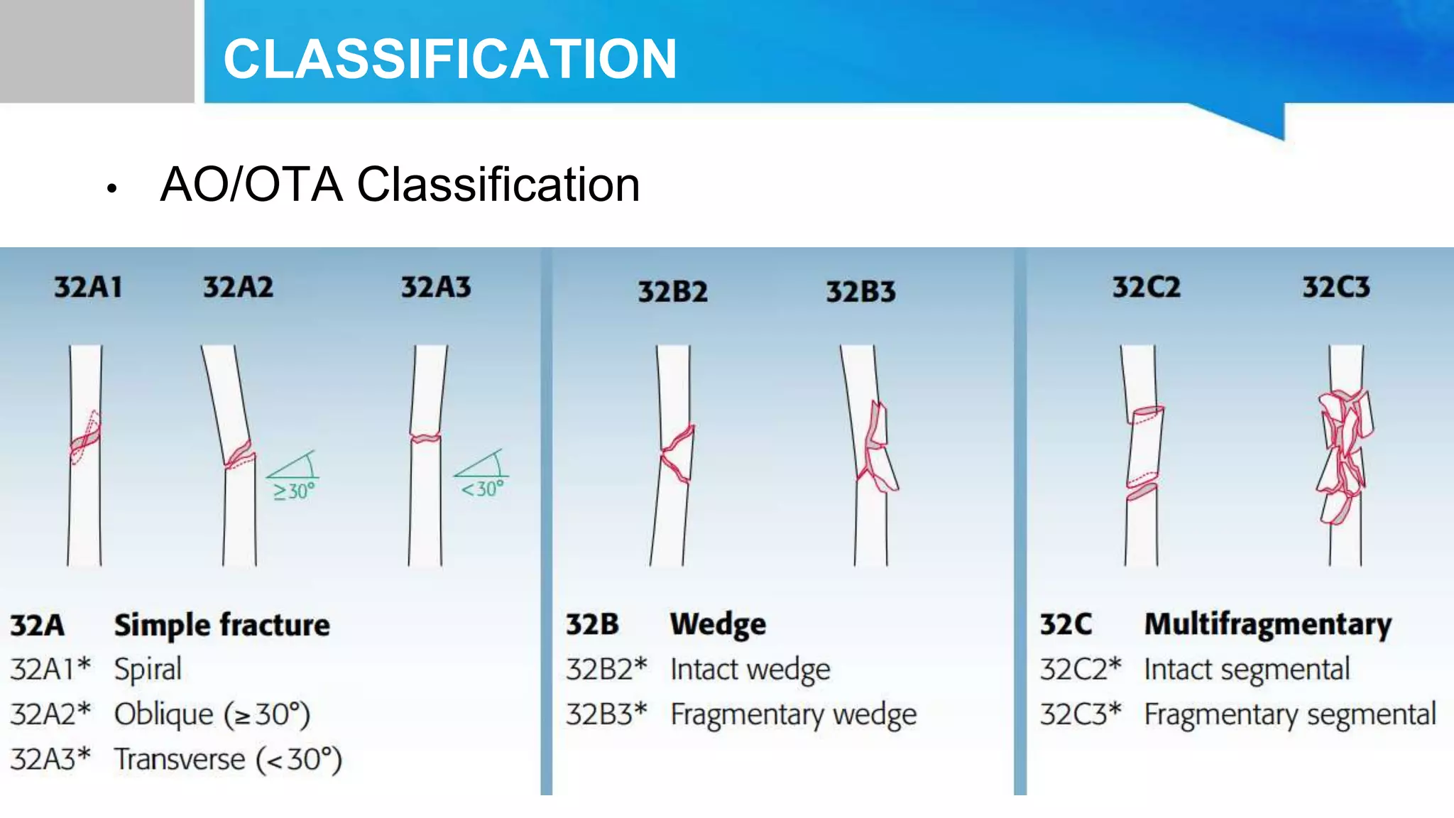 Shaft of femur fracture | PPTX