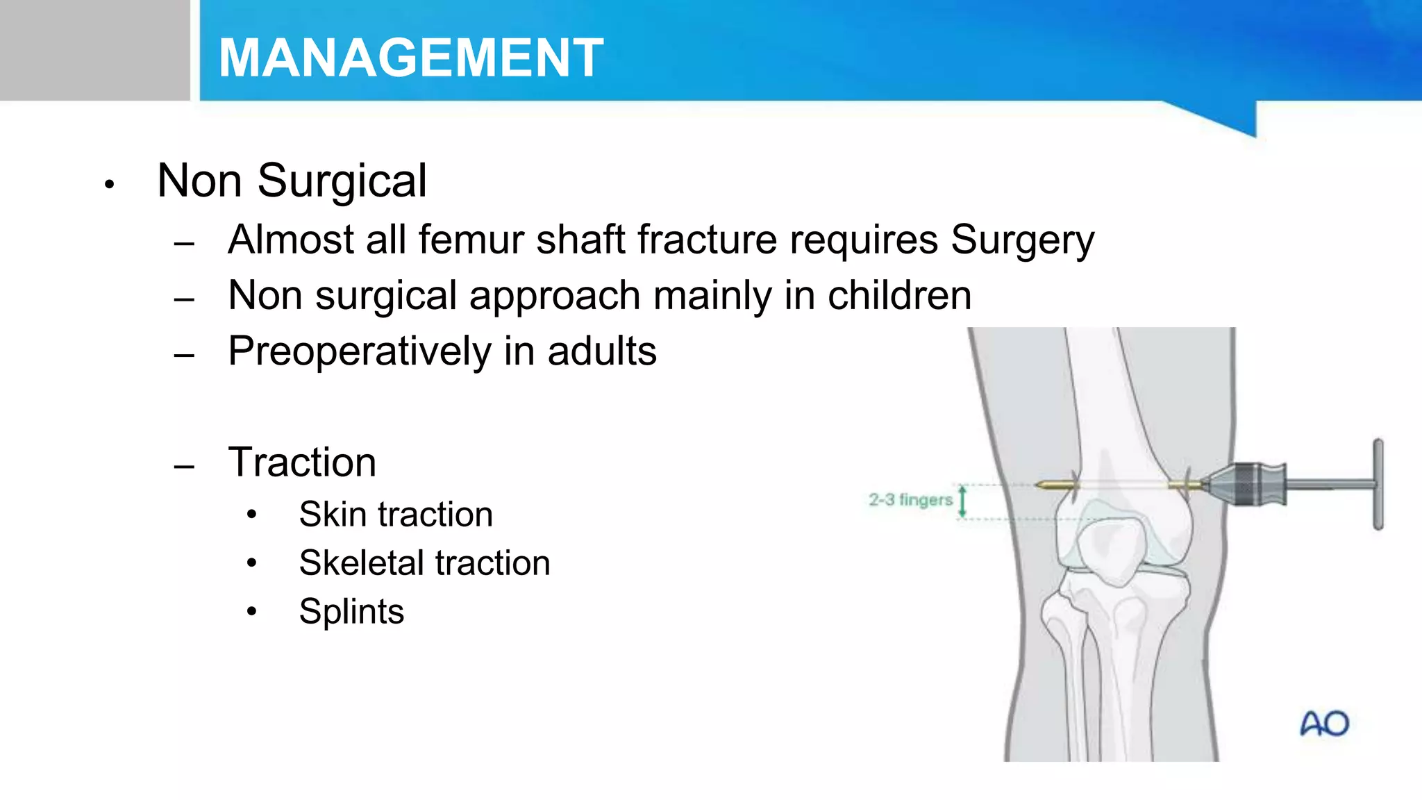Shaft of femur fracture | PPTX