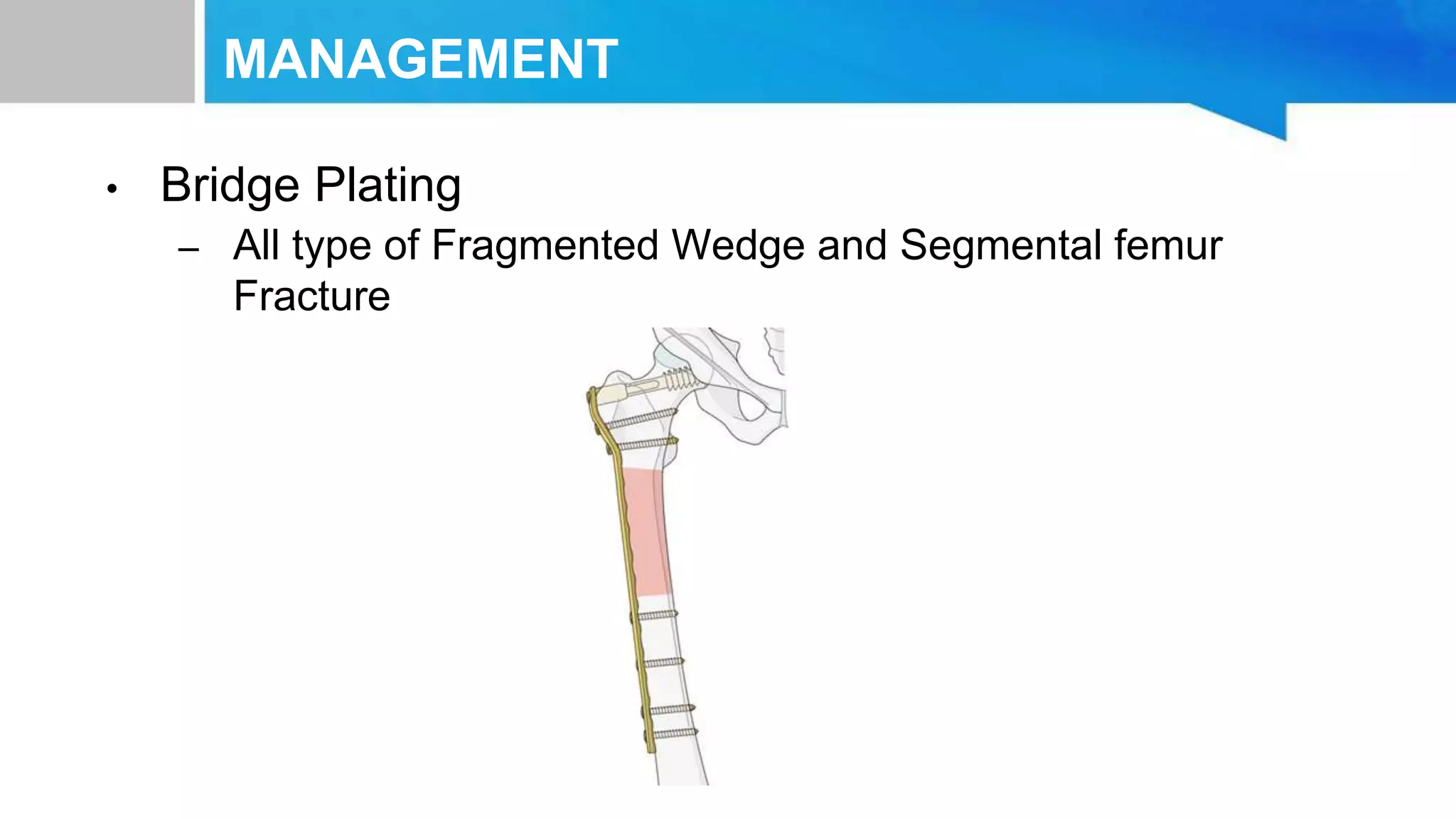 Shaft of femur fracture | PPTX