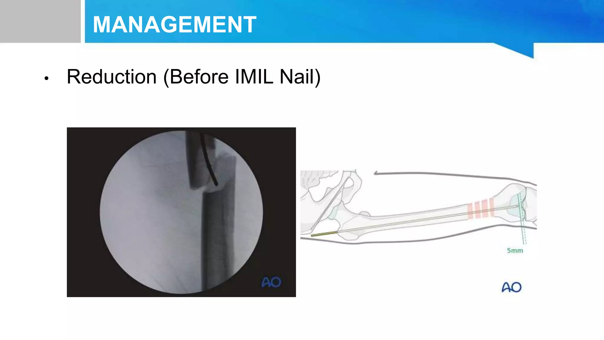Shaft of femur fracture | PPTX