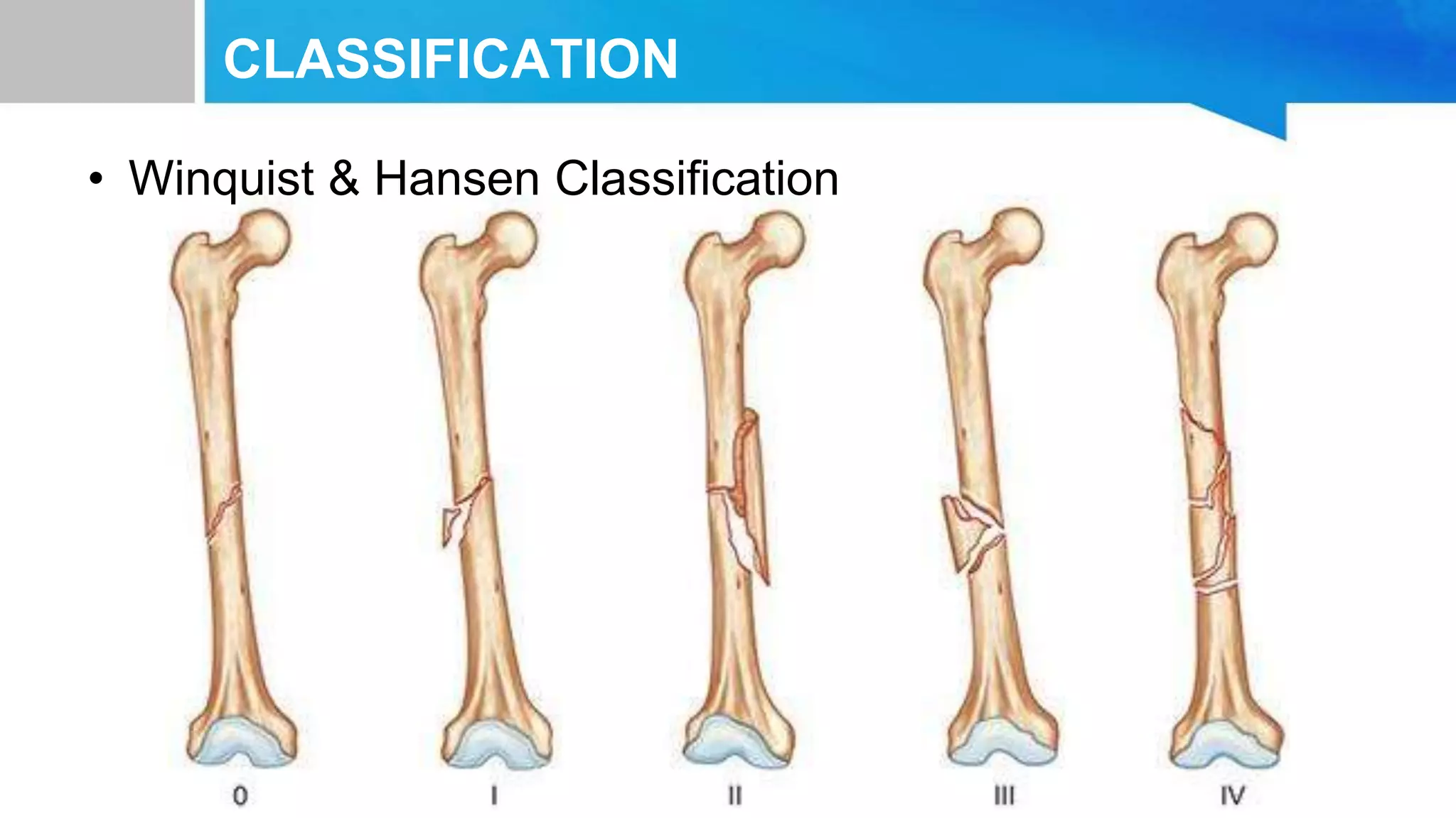 Shaft of femur fracture | PPTX