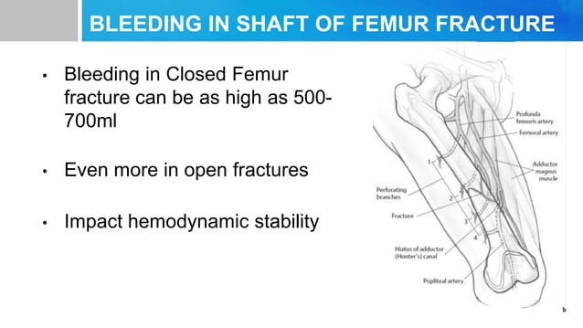 Shaft of femur fracture | PPTX