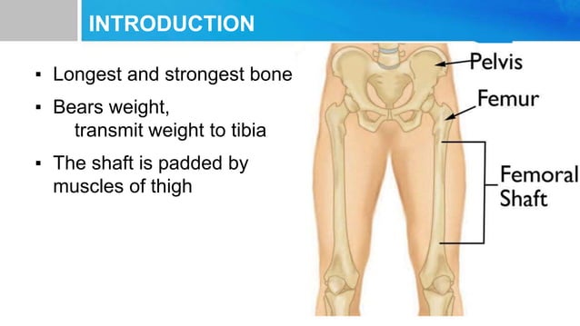 Shaft of femur fracture | PPTX