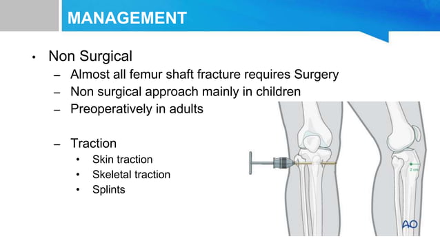 Shaft of femur fracture | PPTX