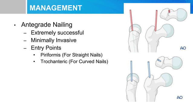 Shaft of femur fracture | PPTX