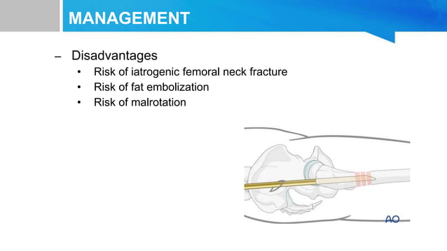 Shaft of femur fracture | PPTX