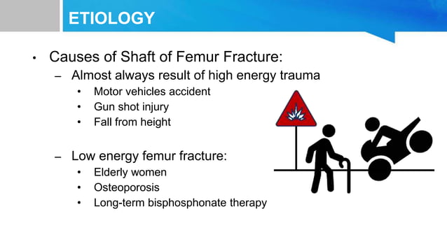 Shaft of femur fracture | PPTX