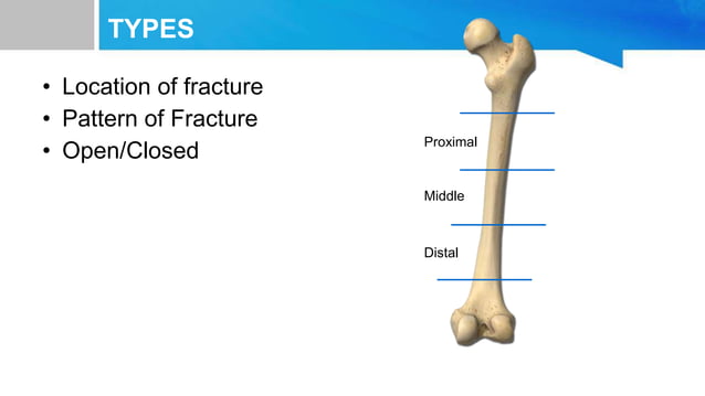 Shaft of femur fracture | PPTX