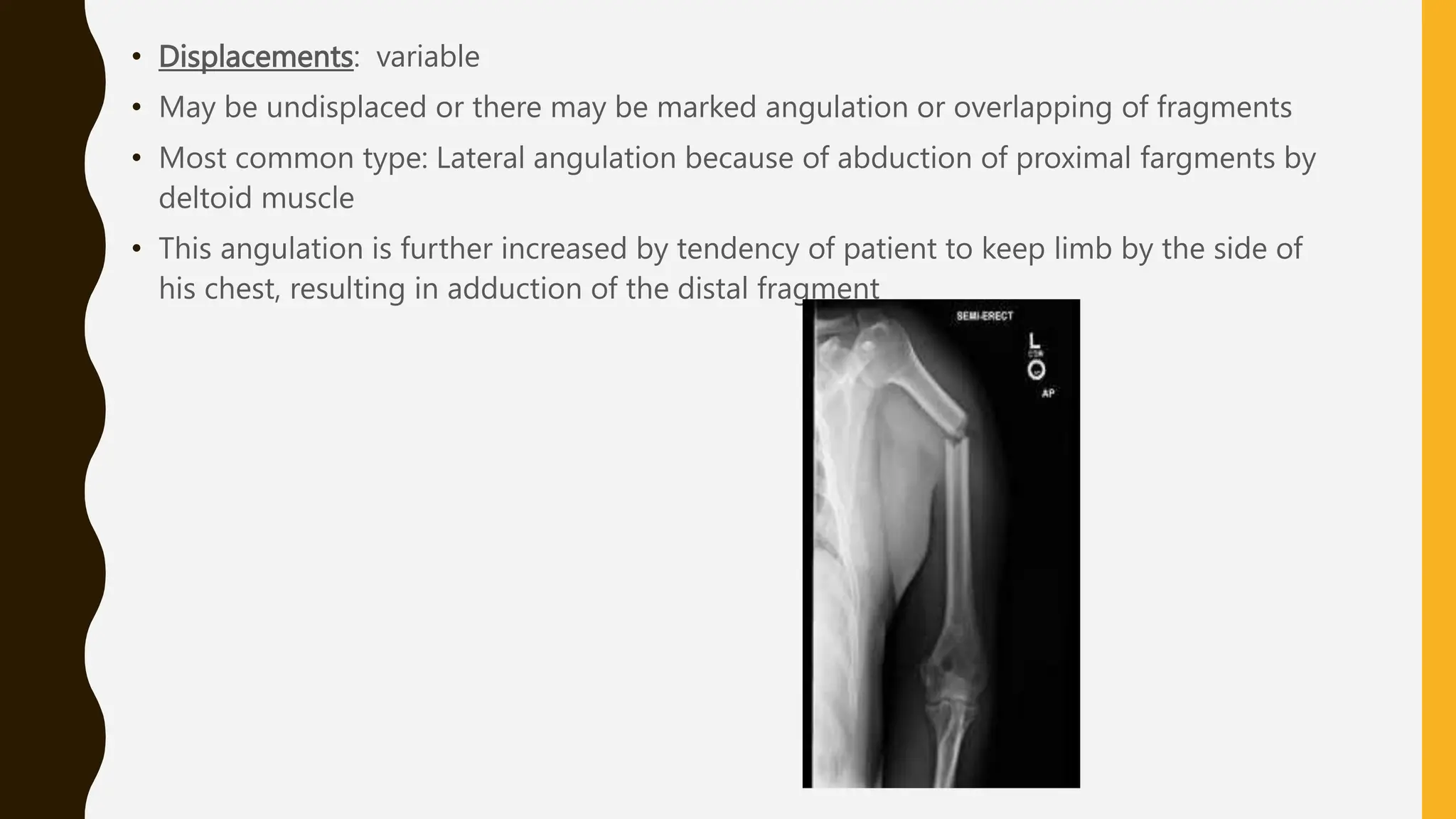 shaft of humerus fracture orthopedics ppt | PPTX