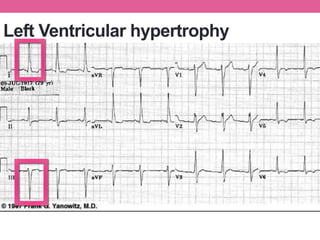 ECG | PPTX