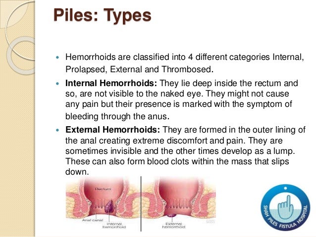 fissure hospital ahmedabad | PPTX