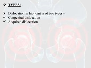 Dislocation of hip joint | PPTX
