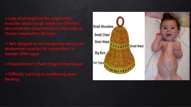 spinal muscular atropy- ayurveda