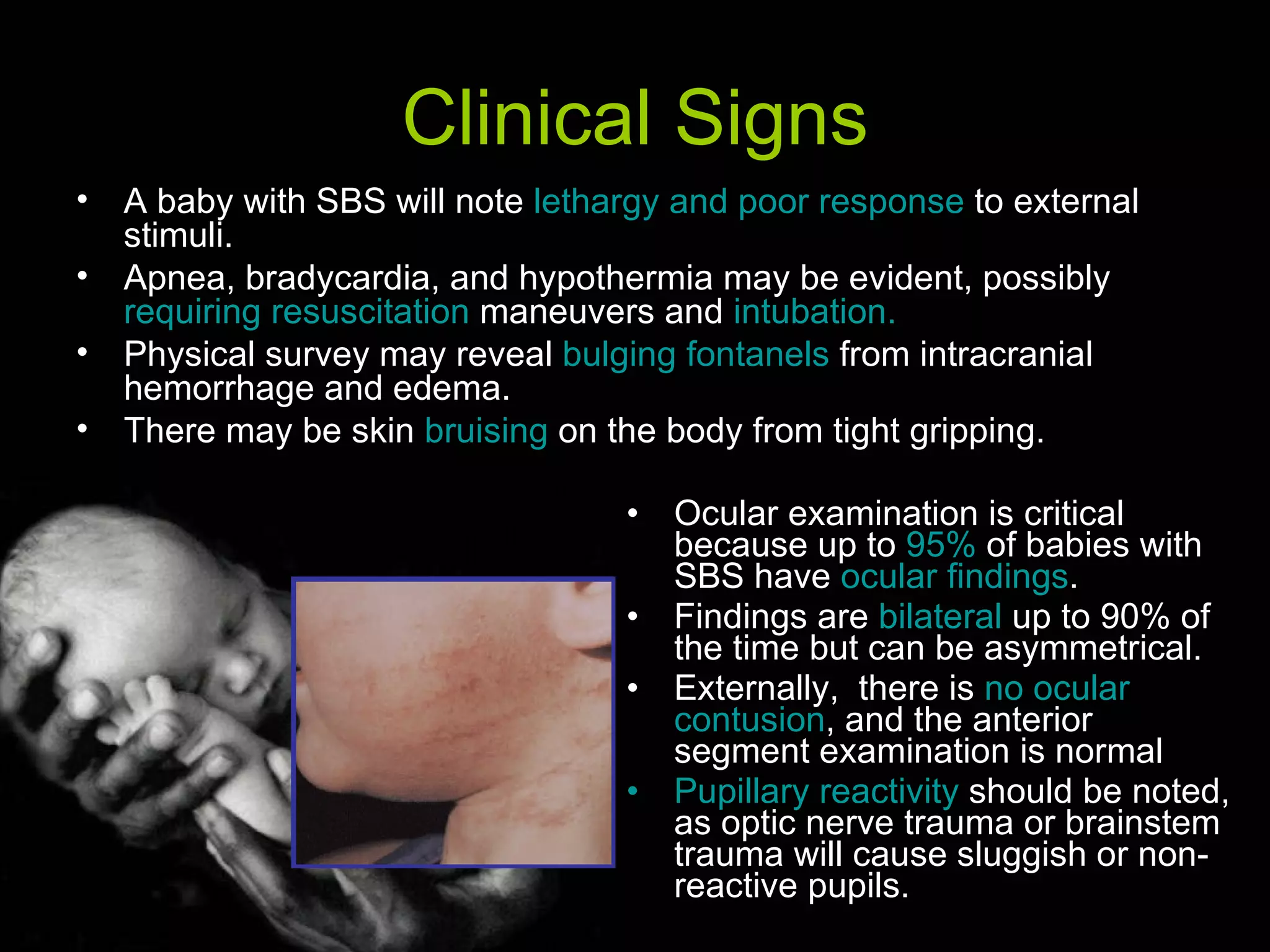 Shaken baby syndrome | PPT