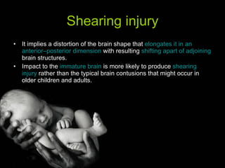 Shaken baby syndrome | PPT