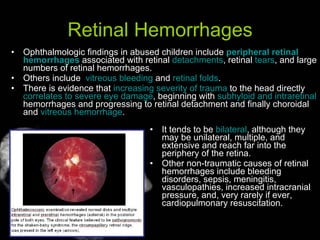 Retinal Hemorrhage Shaken Baby