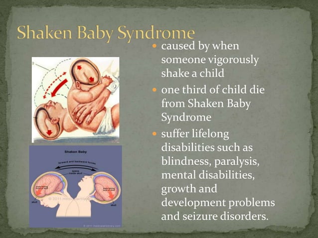 Shaken baby syndrome | PPTX