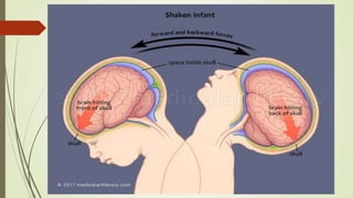 Shaken Baby Syndrome Cause and Effect , Signs and Symptoms Management ...