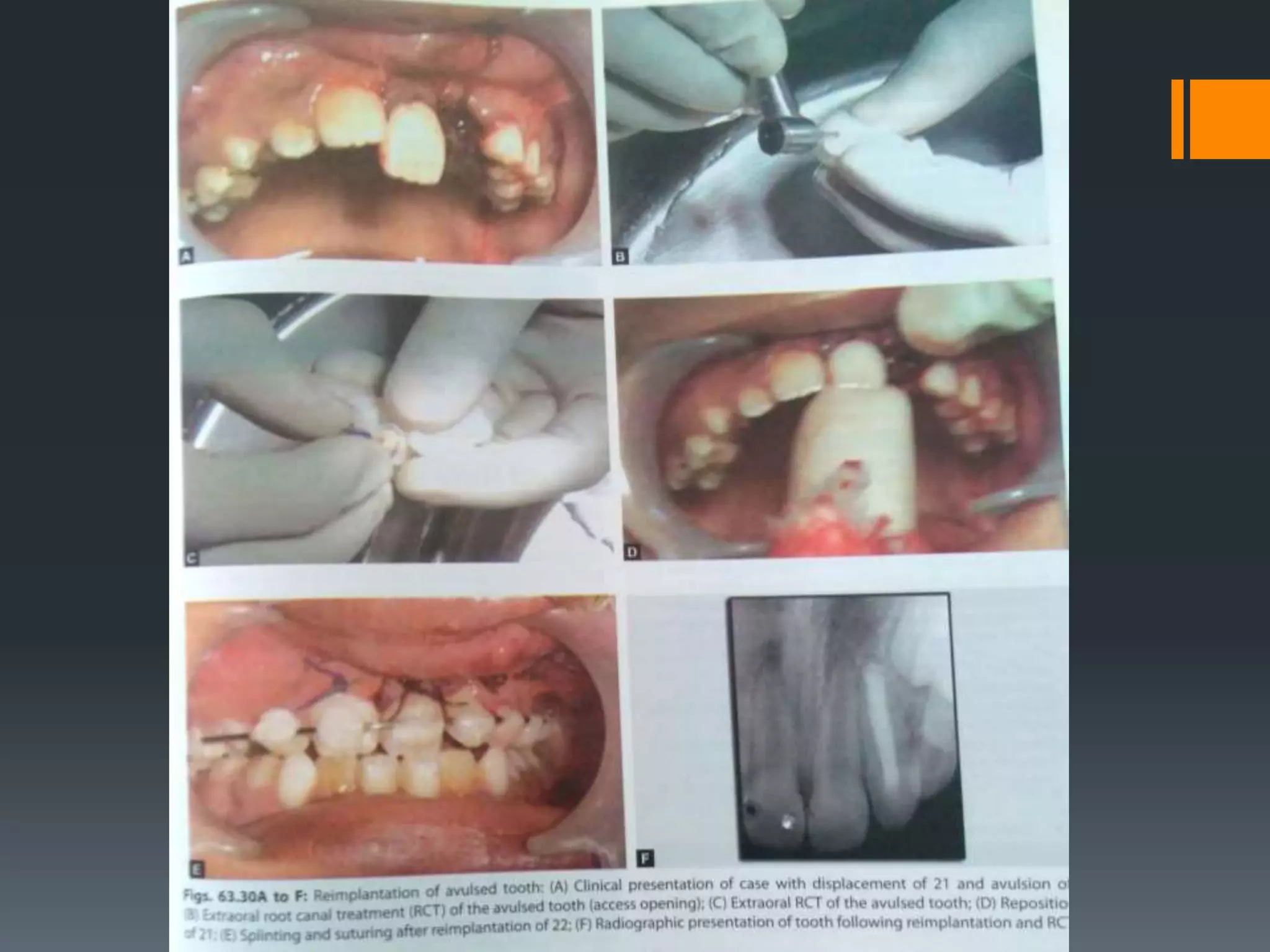 Dental Avulsion | PPTX