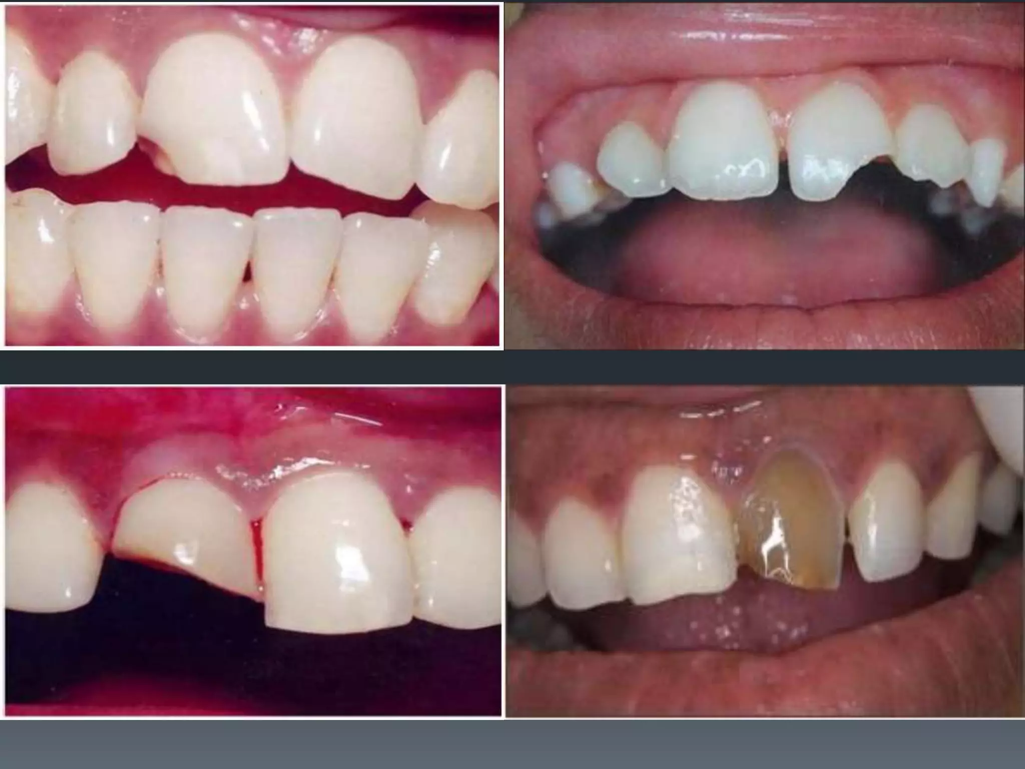 Dental Avulsion | PPTX
